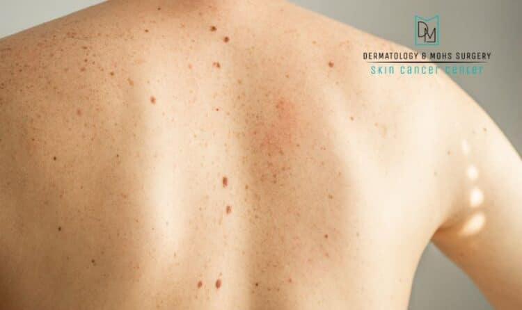 10 Symptoms Of Skin Cancer