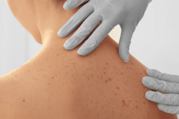 Surgical Dermatology Archives - Dermatology and Mohs Surgery Skin ...