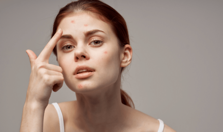 The Ultimate Guide to Acne: Types, Triggers, and Treatments ...