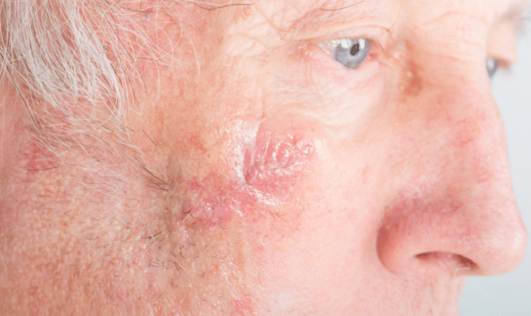 Recovery Timeline After Mohs Surgery: Your Guide to Healing