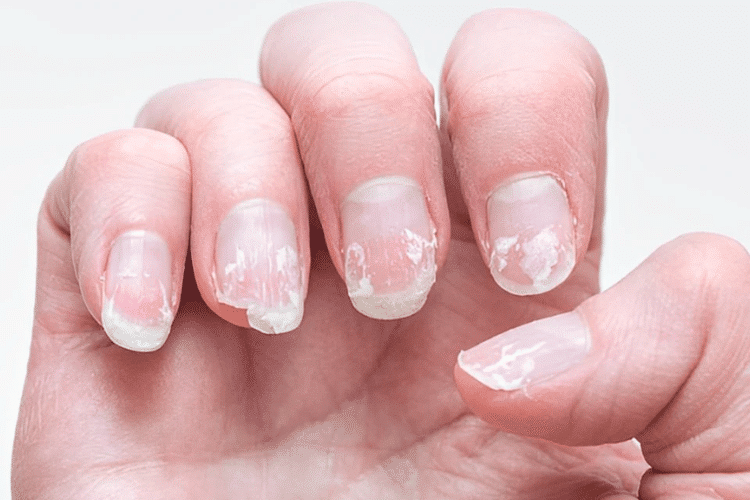 Nail Disorders Archives - Dermatology and Mohs Surgery Skin Cancer Center