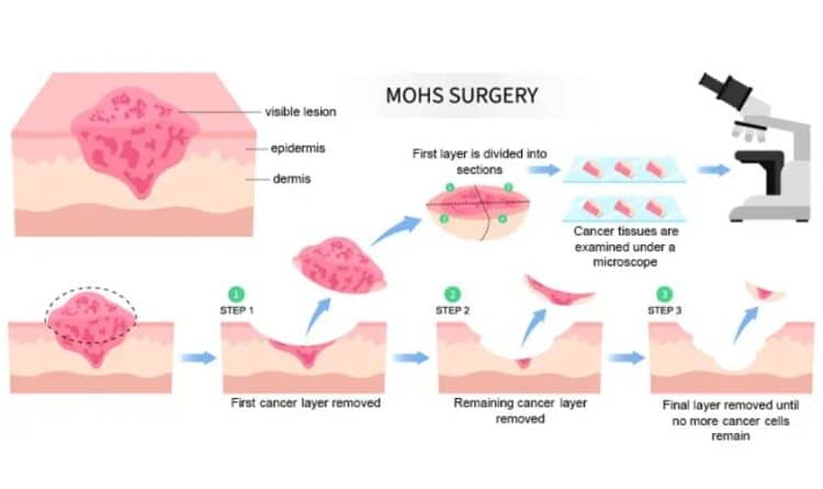 Does Mohs Surgery Leave a Hole? Understanding Mohs Surgery Results ...